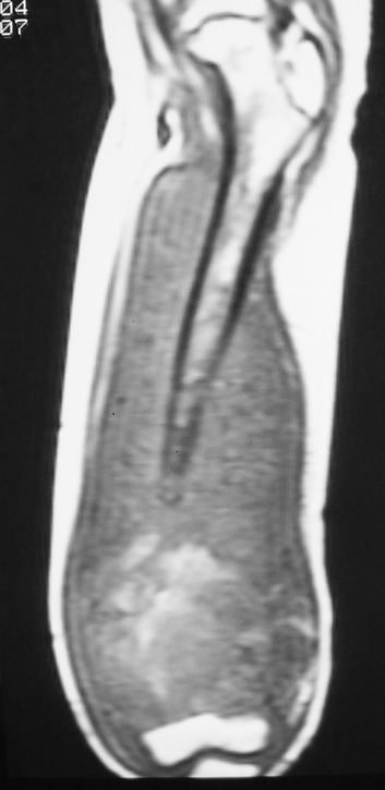 Telangiectatic Osteosarcoma Pathology Orthobullets